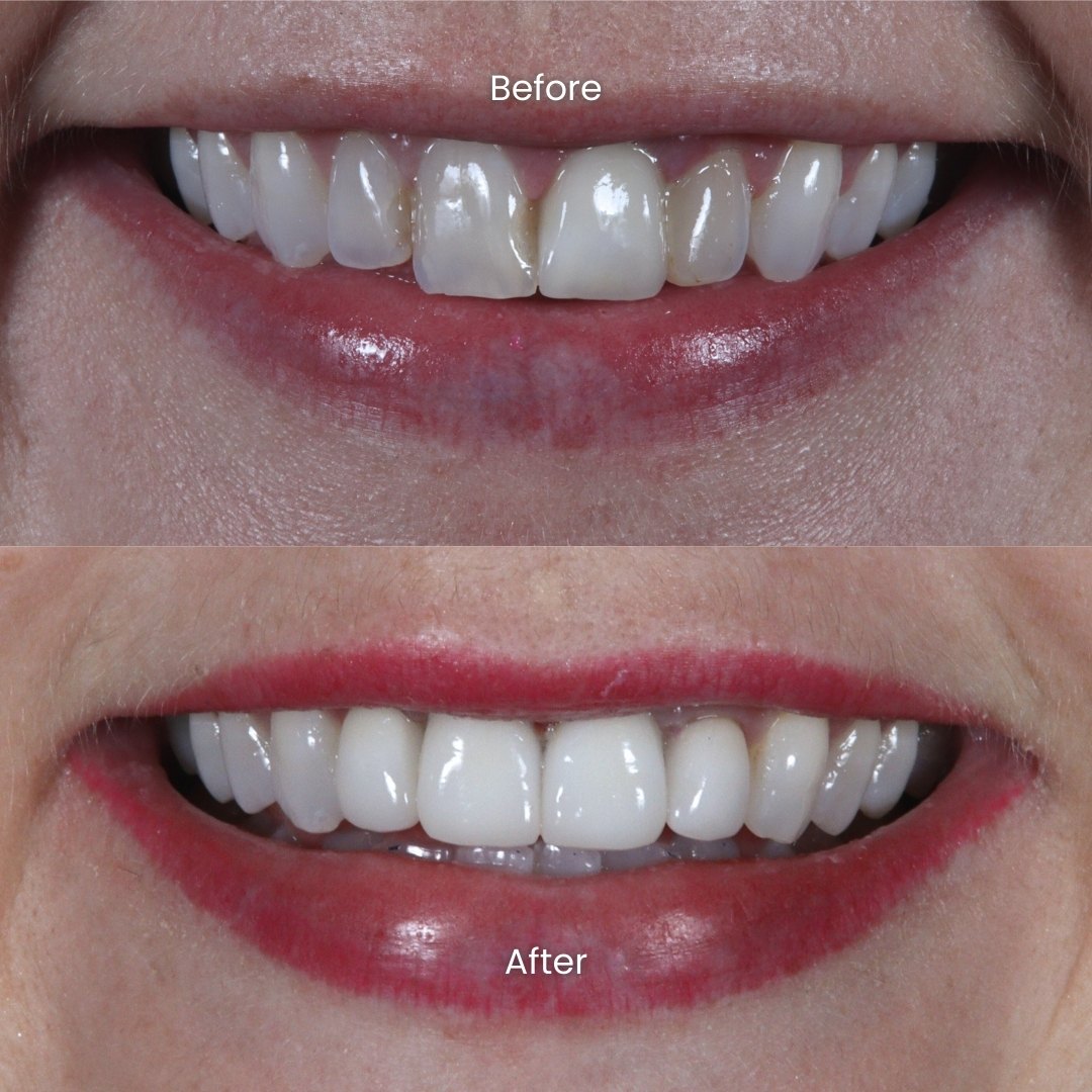 Before & After Dental Implants, Veneers & Smile Transformations